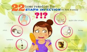 22 Home Remedies For Staph Infection On Face & Scalp