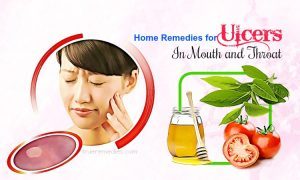 27 Simple But Effective Home Remedies For Ulcers In Mouth