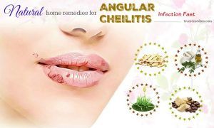 25 Natural Home Remedies For Angular Cheilitis Infection Fast