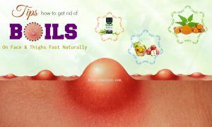 21 Tips How To Get Rid Of Swollen Lip Symptoms Fast At Home