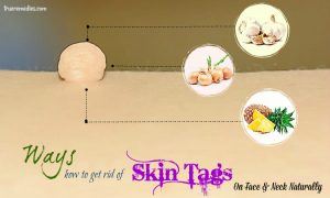 30 Ways How To Get Rid Of Skin Tags On Face & Neck