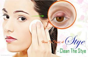 26 Ways How To Treat A Stye On Eyelid & Inside Eye Fast At Home