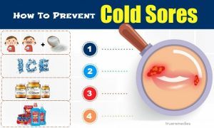 24 Tips How To Prevent Cold Sores On Lips, Nose & Inside Mouth