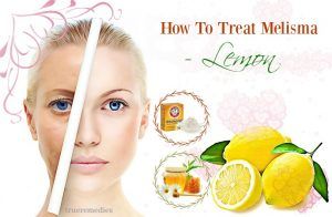 10 Tips On How To Treat Melasma On The Face & Upper Lip