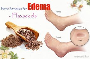 17 Home Remedies For Edema In Hands, Legs, Ankles & Feet