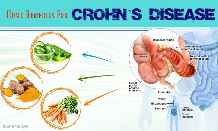 20 Natural Home Remedies For Crohn’s Disease Symptom Relief