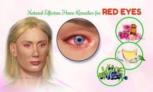 27 Natural Effective Home Remedies For Red Eyes Infections